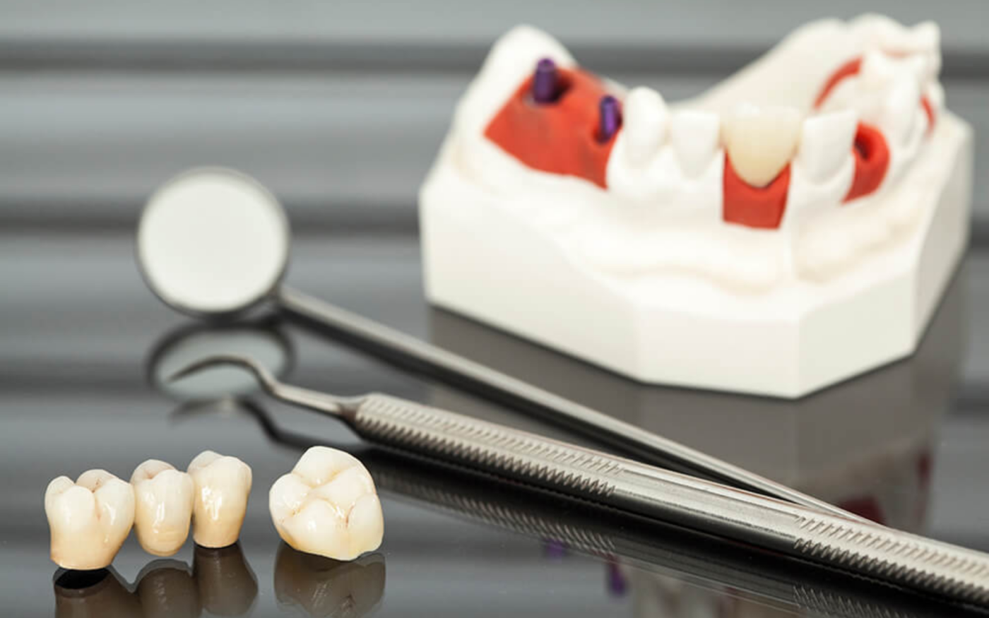 What To Do When Your Dental Crowns Break: A Guide